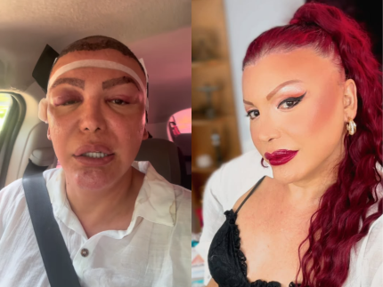 Luisa Marilac mostra rosto inchado após transplante capilar - Portal ...